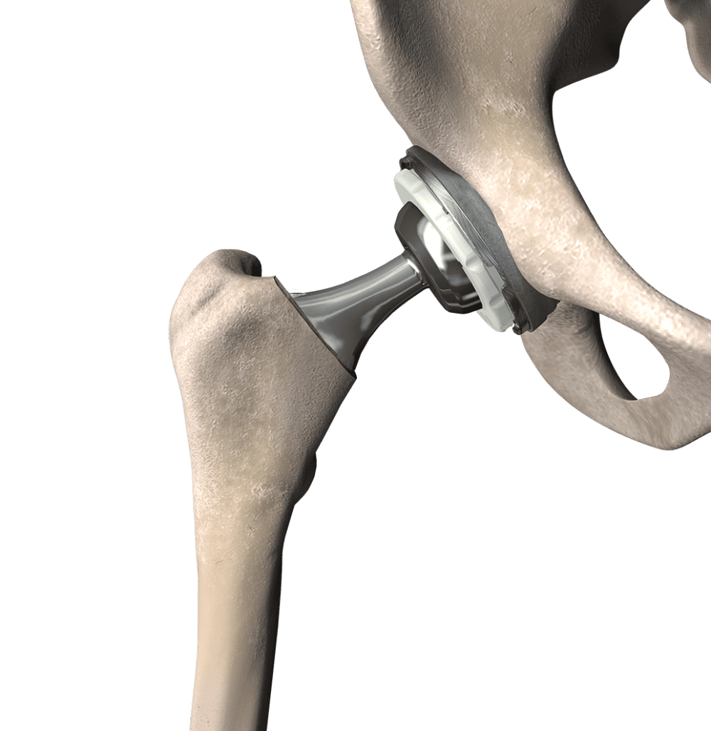 HIP REPLACEMENT SURGEON Airmid Hospital