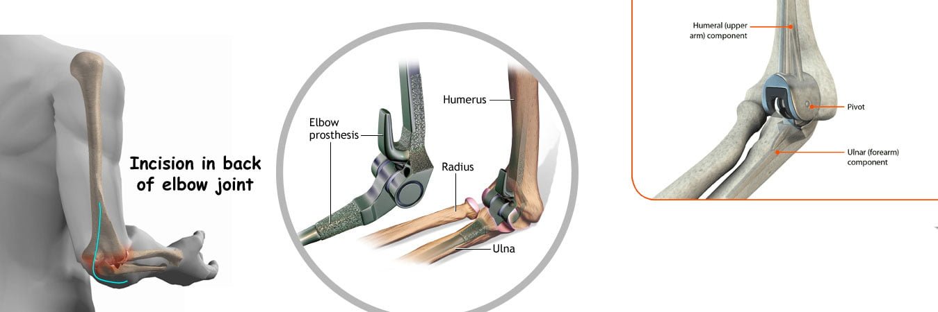 ELBOW REPLACEMENT - Airmid Hospital
